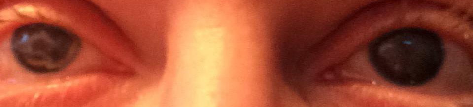 About – Aniridia Day